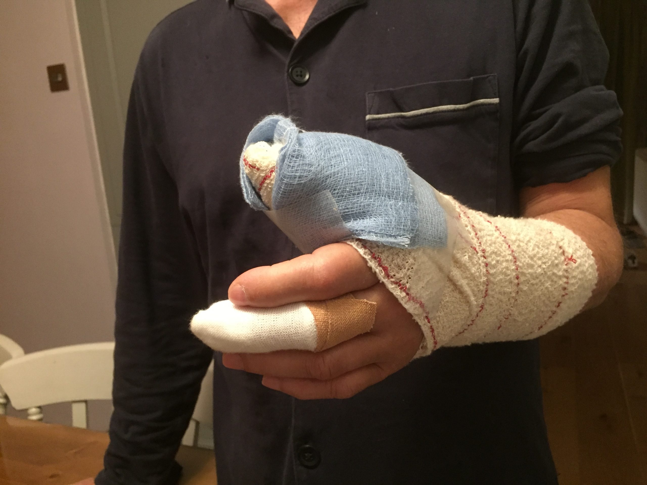 QVH hand experts save granddad John’s thumb - Queen Victoria Hospital